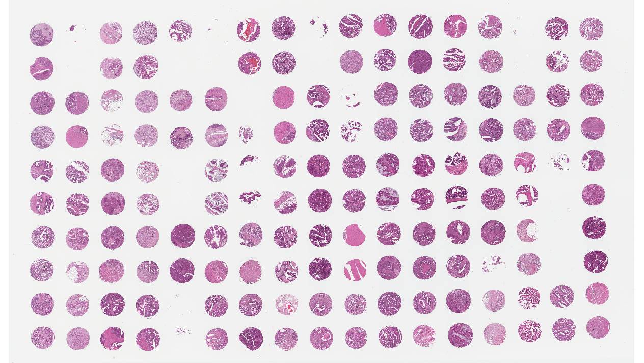 CRC primary with Bevacizumab treatment & follow up data (metastatic ...