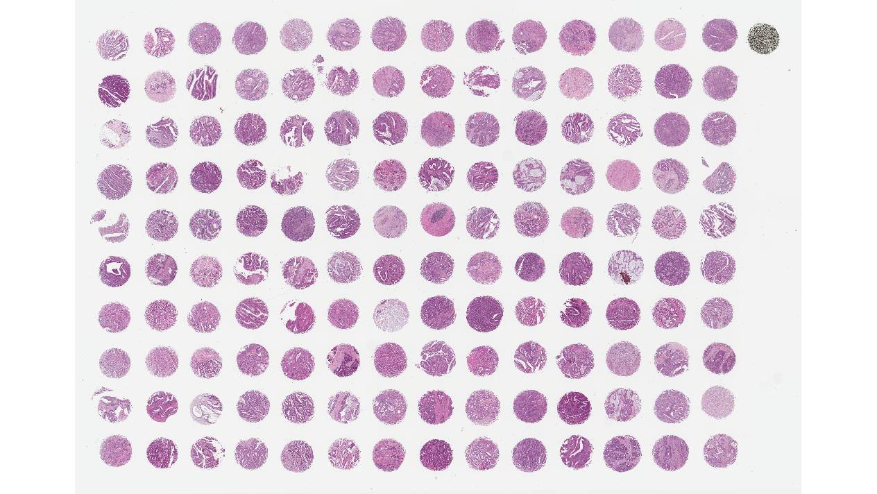 CRC with histopath & HER2 IHC data (TA3130) - TriStar Technology Group