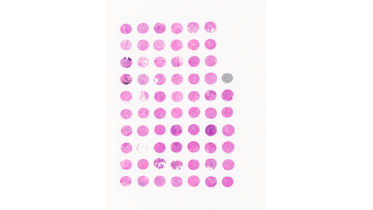 NSCLC primary & matched nodal mets with histopath data (TA4303 ...